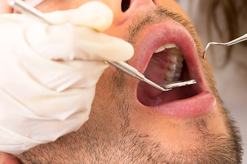 New method to test for oral cancer - ERRIS DENTAL